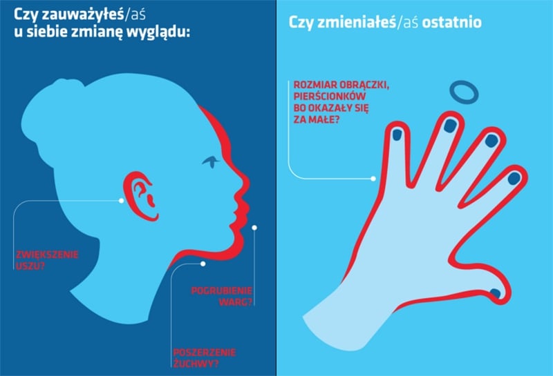 Akromegalia – mało znana choroba dużych ludzi - Magazyn Informacyjny ...